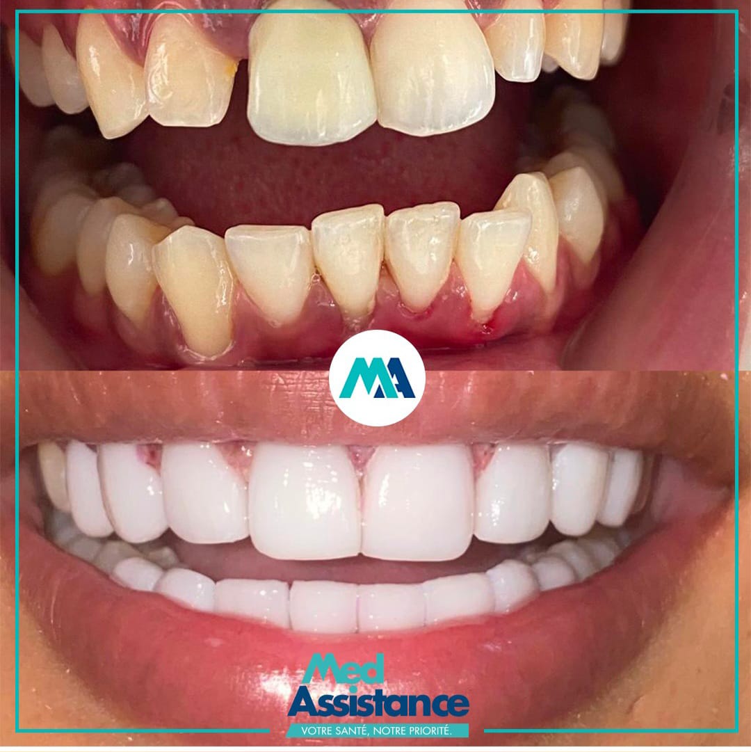 Facettes dentaires : types, prix, pose et entretien